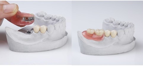 Semi Precision Attachment Abutment